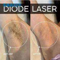 China Ice Speed L 3 Wavelength Oem Commercial 808 Diode Laser Hair Removal Machine for sale