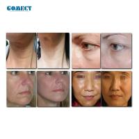 China Professional Fractional Microneedle Face Lifting Rf Microneedling Machine for sale