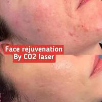 China 60W Fractional Skin Resurfacing Acne Treatment Anti Puffiness CO2 Laser Fractional Vaginal Tightening Machine for sale