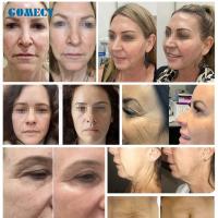 China RF Microneedling Machine For Acne Sca RF Microneedle Handle Head With Cable Portable for sale