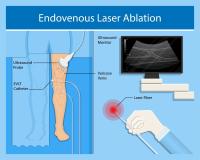 China EVLT Varicose Vein Removal Machine Radial Fiber Laser EVLT Endovenous Ablation Treatment Machine for sale