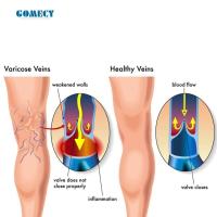 China EVLT Varicose Vein Removal Machine Radial Fiber Laser EVLT Endovenous Ablation Treatment Machine for sale