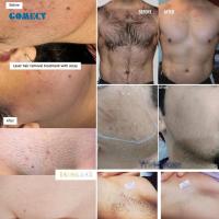 China GOMECY Diode Laser Machine for Permanent Hair Removal 755 808 940 1064Nm 4 Wavelengths for sale