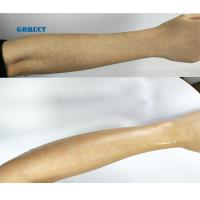 China 755 808 1064nm OEM Diode Laser Hair Removal Device for Ozero Khanka Pioneer for sale
