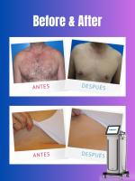 China 755 808 1064nm OEM Diode Laser Hair Removal Device for Ozero Khanka Pioneer for sale