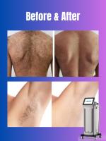 China 755 808 1064nm OEM Diode Laser Hair Removal Device for Ozero Khanka Pioneer for sale