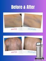 China 755 808 1064nm OEM Diode Laser Hair Removal Device for Ozero Khanka Pioneer for sale