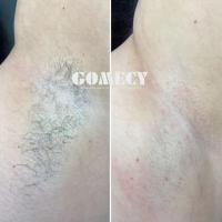 China CE Approved Triple Wave 3D 4D 4 Wave Diode Laser Ice 755 808 940 1064 Diode Laser Hair Removal Machine Titanium Diode Laser Hair Removal for sale