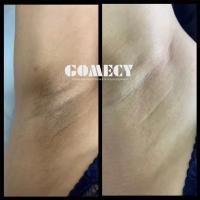 China Permanent Hair Removal Equipment 755nm 1064nm Long Pulsed Nd YAG Laser Alex Max Pro for Effective Results for sale