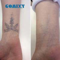China Q Switched ND Yag Laser Machine 2000W High Energy And 6 Functions 100-2000J For Remove Age Pigmented Birthmarks for sale