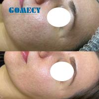China Q Switched ND Yag Laser Machine 2000W High Energy And 6 Functions 100-2000J For Remove Age Pigmented Birthmarks for sale