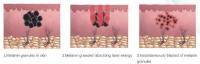 China 532nm 755nm 1064nm Vertical Q Switch Picosecond Laser for Acne Removal for sale