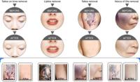 China 532nm 755nm 1064nm Vertical Q Switch Picosecond Laser for Acne Removal for sale