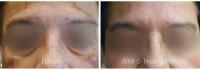 China 532nm 755nm 1064nm Vertical Q Switch Picosecond Laser for Acne Removal for sale