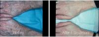 China 532nm 755nm 1064nm Vertical Q Switch Picosecond Laser for Acne Removal for sale