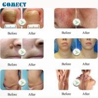 China Gomecy Medical Class IV Diode 980nm 810nm Laser Therapy Machine for EVLT and Function 3 Endolift Double Chin Slim for sale