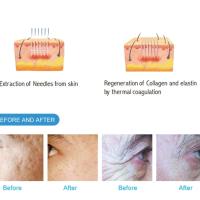 China Gold RF Microneedle-Machine Vertical Fractional RF Microneedle Face and Body Tightening Lifting Treatment for sale
