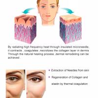 China Gold RF Microneedle-Machine Vertical Fractional RF Microneedle Face and Body Tightening Lifting Treatment for sale