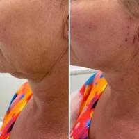 China 980nm 1470nm Endolaser Face Lift Lipolysis Machine Diode Laser Fat Removal Endolifting Lipolysis Laser Liposuction Equipment for sale