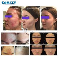China 2025 Gomecy Cold Plasma Machine For Skin , Beauty Plasma Lifting Machine for sale