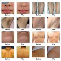 China Advanced 4 Wavelength Diode Laser Hair Removal Machine 755nm 808nm 940nm 1064nm Permanent Painless Epilation System for sale