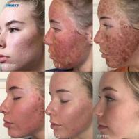 China CO2 Fractional Laser Device with Touchscreen Interface for Advanced Skin Therapy Wrinkle Removal and Lifting for sale