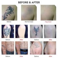 China Water Cooling Air Cooling Tec Cooling Q Switched ND YAG Laser Tattoo Removal Machine for Professional for sale