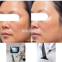 China 532nm Carbon Peeling ND YAG Laser Beauty Machine for Pore Shrinking High Energy Solid Laser Equipment for Birthmark and Naevus Removal for sale