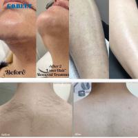 China AI Analysis Diode Laser Hair Removal Machine for sale