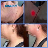 China 980nm 1470nm 635nm Endolift Laser Machine for sale