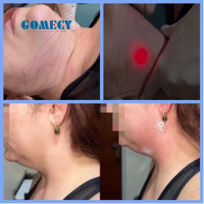 China Endolift Laser Machine for Spider Veins/face Veins Removal and Lipolysis/Liposuction Fat Melting Pulse Duration 0-999s for sale