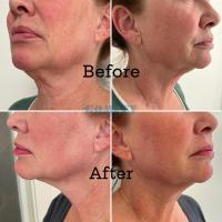 China Factory Supply 1470 Laser Wrinkle Removal Skin Rejuvenation Skin Tightening Machine for sale