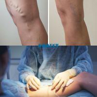 China Dual Wavelength 980nm 1470nm Diode Laser Medical System for Endovenous Vein Treatment, Varicose Vein Closure, Leg Vein Therapy, Vascular Surgery, Minimally Invasive Vein Removal Device for sale