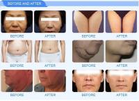 China Hifu Beauty Machine Hifu  12d Hifu Face Wrinkle Lift Skin Tightening Body Slimming for sale