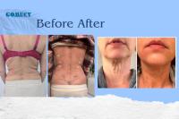 China Advanced 980 1470nm Endolaser Machine for Face Lifting and Vascular Treatments for sale