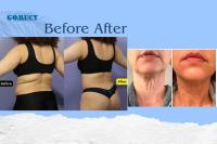 China 980 1470nm Dual Laser Device for Minimally Invasive Face Lift and Varicose Vein Care for sale