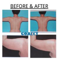 China 980nm / 1470nm Endolift Laser Machine for Face Lift and Double Chin Shaping with Semiconductor Laser Therapy for sale