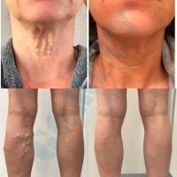 China Advanced 980nm 1470nm 635nm Triple Wavelength Diode Laser System for Vascular Therapy Lipolysis Skin Repair and Dermatology Clinics for sale