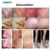 China Electrolysis System Permanent Solution Removing  Hair Colors and Vascular Removal Machine for sale