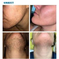 China Electrolysis System Permanent Solution Removing  Hair Colors and Vascular Removal Machine for sale