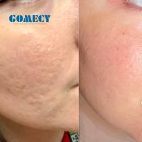 China RF Microneedle Technology for Effective Skin Tightening Treatments for sale