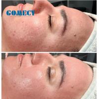 China RF Microneedle Technology for Effective Skin Tightening Treatments for sale