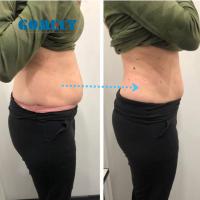 China 980nm 1470nm endolaser face lift lipolysis machine diode laserfat removal endolifting lipolysislaser liposuction equipment for sale