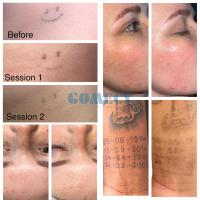 China High Power 2000W Pico Laser Machine Q Switched Nd YAG Laser for Professional Tattoo Removal Clinic Age Spot Sun Spot Freckle Removal Non Invasive Carbon Peel Skin Rejuvenation Device for sale