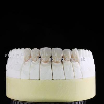 China Dental Pfm Crown And Bridges Pontic Dentures Materials Dental Restorations for sale