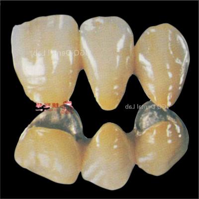 China Porcelain Fused to Metal Crown and Bridge Made in China Dental Lab for sale