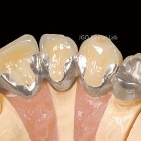 China Porcelain Fused to Metal Crown and Bridge Made in China Dental Lab for sale