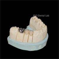 China Porcelain Fused to Metal Crown and Bridge Made in China Dental Lab for sale