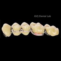 China Porcelain Fused to Metal Crown and Bridge Made in China Dental Lab for sale