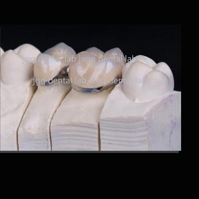 China Dental Alloy Metal Ceramic Crown Dental Restoration Porcelain Fused Metal Teeth for sale